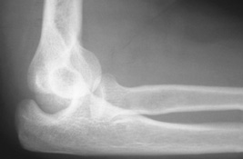 Vipal Dua, MD: Elbow Dislocation - Providing Shoulder, Mako Robotic-Arm ... Vipal Dua, MD: Elbow Dislocation - Providing Shoulder, Mako Robotic-Arm ...